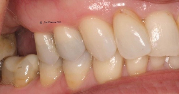 Clinical photos - Dental Implants | Lake Loon Family Dentistry